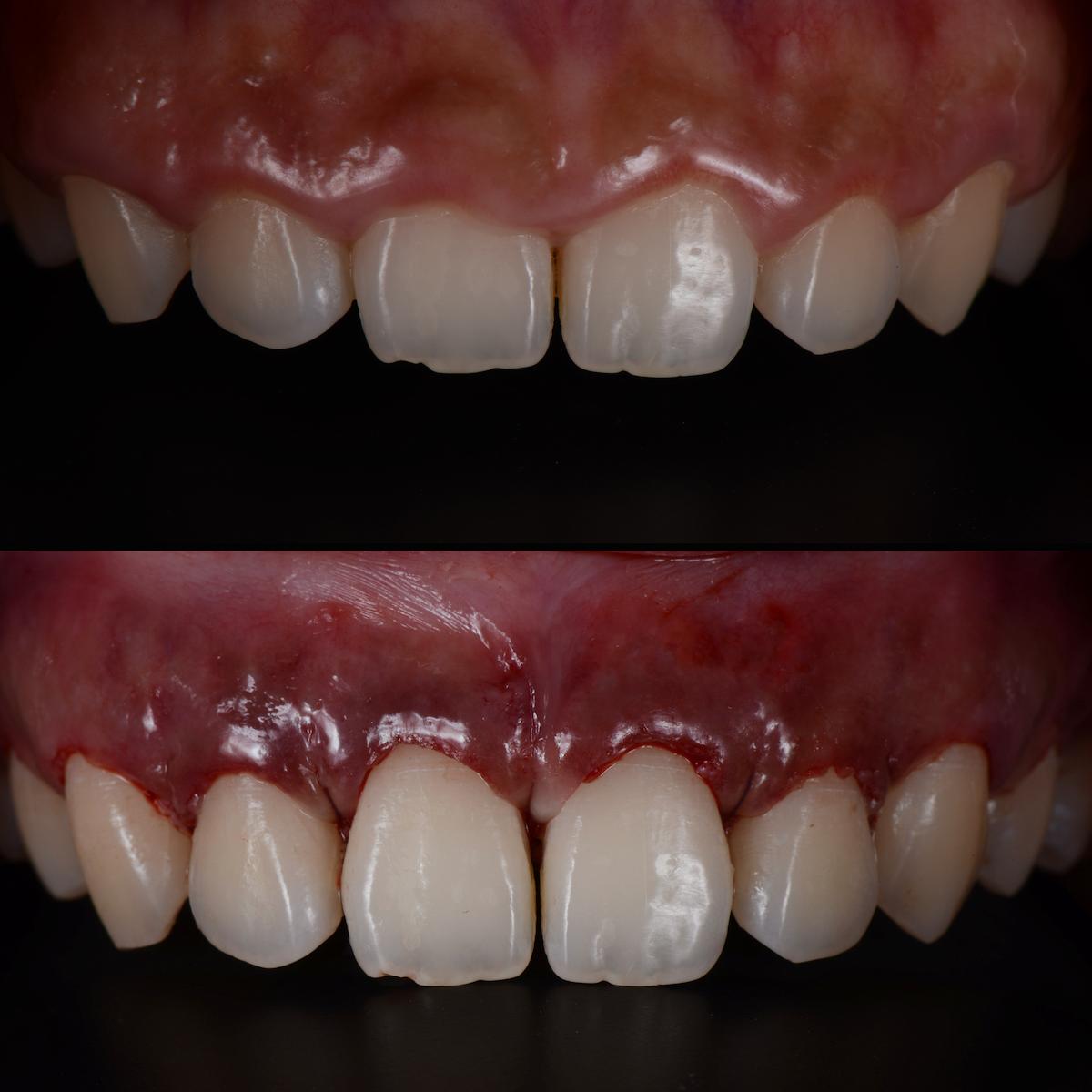 What is a Gum Lift? - Dalton Dental